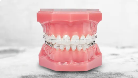 Your Perfect Smile with Braces in Tijuana | Smile Together Tijuana.